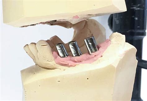 Protesi E Supporto Implantare Fissi O Removibili 3DsmileFactory