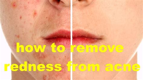 How To Remove The Redness Of A Pimple Youtube