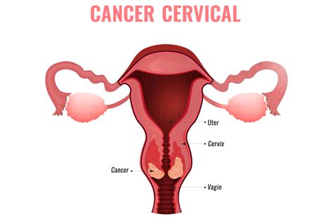 Cancerul De Col Uterin Preven Ie Simptome I Metode De Tratament Dr