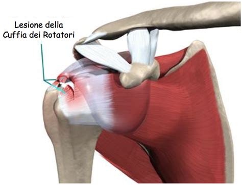 Lesioni Della Cuffia Dei Rotatori Fisiokinetica Centro Di Riabilitazione