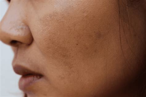 Deep Rejuvenation MediFacial Singapore Ensoul Medical Clinic