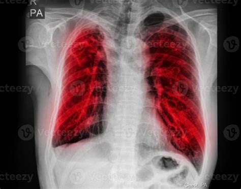 Pulmonary Tuberculosis Tb Chest X Ray Show Alveolar I Vrogue Co The