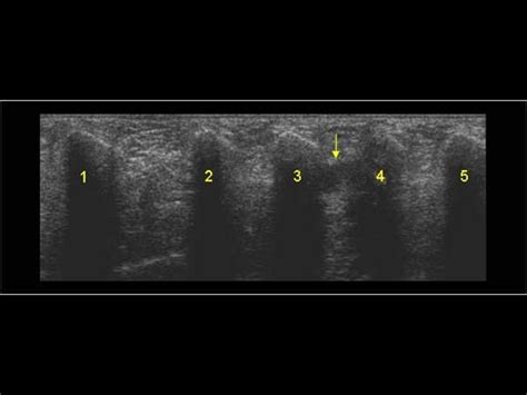 Neuroma Ultrasound Nerve Defined Focal Medicine Common Radio Middle