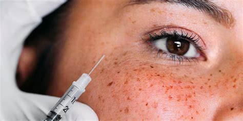 Cuánto dura el Botox Le pedimos a los dermatólogos que nos dieran una