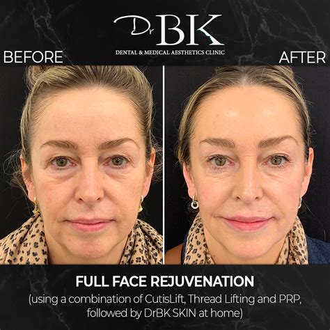 DrBK Lift Non Surgical Face Lift At DrBK