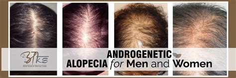 Androgenetic Alopecia For Men And Women Hair Treatment Clinic