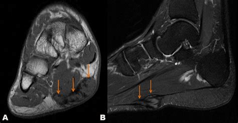 Plantar Fibromatosis Mri