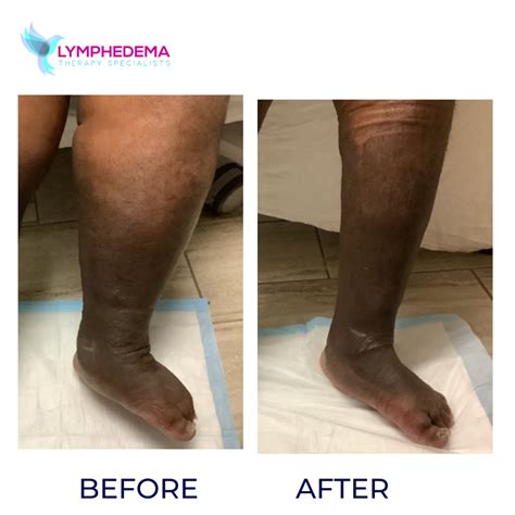 Lymphedema Treatment Before And After