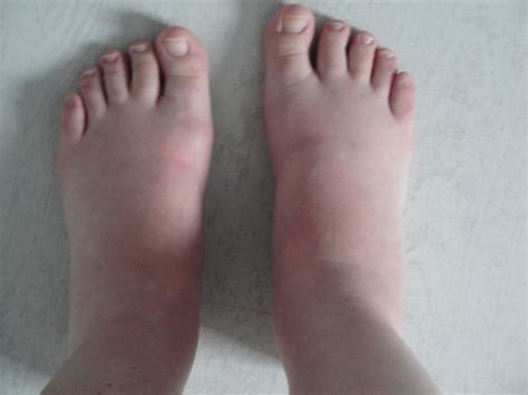 Syndrome de Raynaud remède naturel Remèdes naturels Pied gonflé
