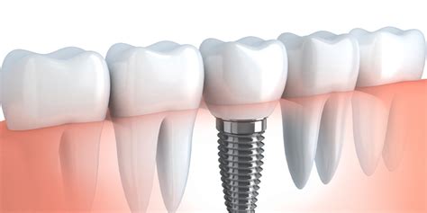 Instant Transformation Embrace Same Day Dental Implants Today