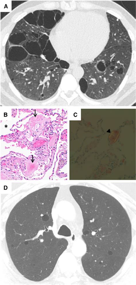 Computed Tomography Ct And Histopathologic Images Of Diffuse Cystic