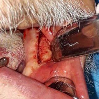 The Clinical Photograph Reveals A Distinct Swelling On The Left Side Of