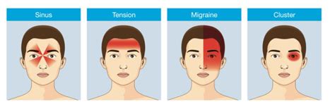 PICTURES Types And Characteristics Of Headache Diagram Quizlet