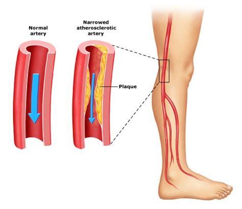 Pinellas Vascular Trusted Care For PAD Claudication Lower Leg Pain