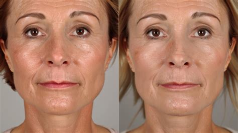 Descubre la radiofrecuencia facial antes y después Lidia Sánchez