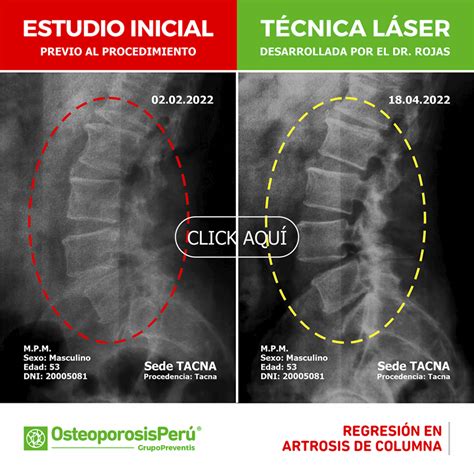 Regresi N En Artrosis De Columna Rx Osteoporosis Per