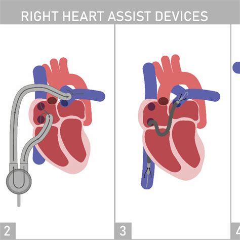 Right Heart Assist Devices 1 Right Ventricular Assist Device With