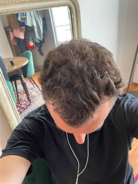 Résultat de Greffe de Cheveux Mois par Mois Le Guide Ultime