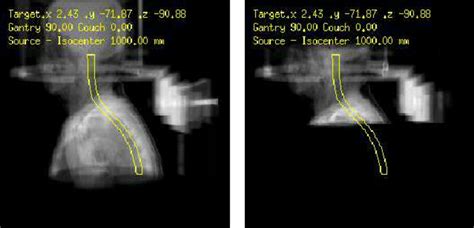 visualization digitally reconstructed radiographs drr in lateral download scientific diagram