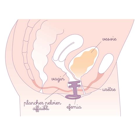 Pessaire Efemia Pour Incontinence Urinaire Chez La Femme Bivea