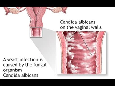 Karakteristika e sekrecioneve vaginale në infeksionin mykotik është