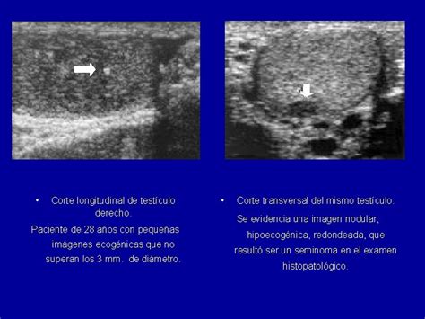 Microlitiasis Testicular Y Sus Asociacin Con El Cncer