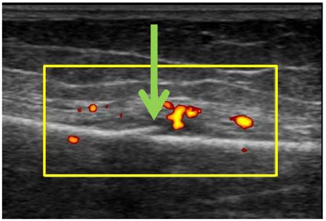 Figure 4 From Knee Ultrasound In Pediatric Patients Anatomy