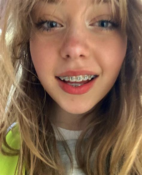Braces Smile Cute Braces Teeth Braces Beautiful Lips Braces Tips