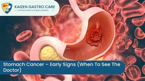 Early Signs Of Stomach Cancer When To See Doctor Kaizen Gastro Care
