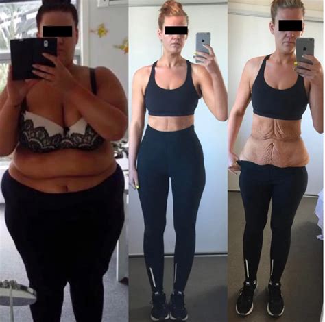photos avant après chirurgie bariatrique tunisie