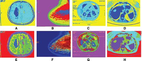 an overview of segmentation algorithms for the analysis of anomalies on medical images