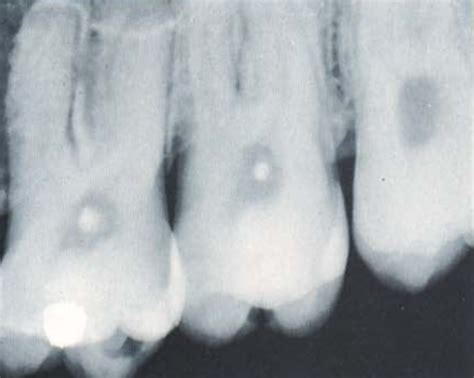 Pictures Of Abnormalities Of Teeth Flashcards Quizlet
