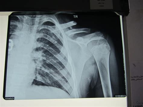 Distal Clavicle Fractures Trauma Orthobullets