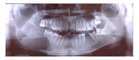 Panoramic View Illustrates A Well Defined Multilocular Radiolucent
