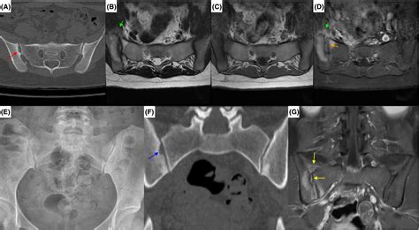 A Case Of Misdiagnosed Sacroiliac Joint Tuberculosis As Axial