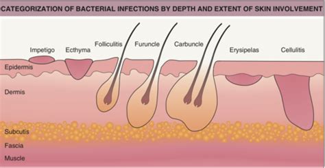 Erysipelas Vs Cellulitis Vs Impetigo