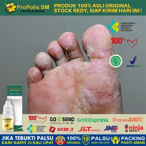 Jual Obat Kuman Air Kuman Air Di Tangan Di Kaki Obat Kuman Air Di
