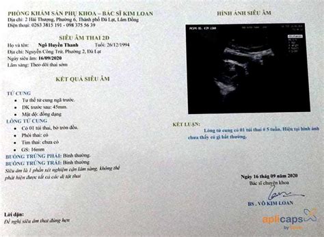 Giấy siêu âm thai có thông tin gì Hình ảnh siêu âm thai các tuần