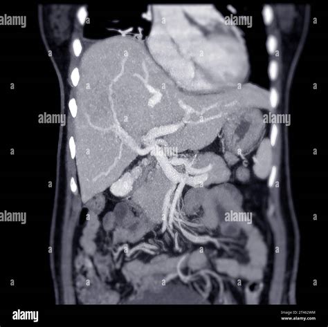 Abdominal ct scan abdomen Fotos und Bildmaterial in hoher Auflösung