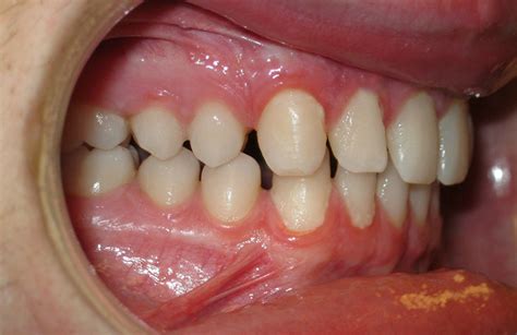 Really Spaced Out Teeth Get Images
