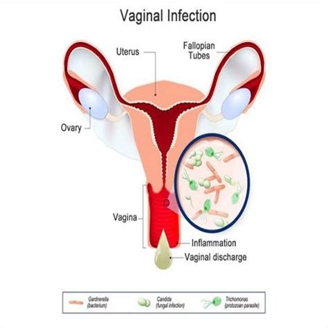 Understanding Abnormal Vaginal Discharge Femheal Women Care