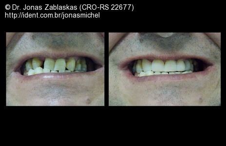 Reabilitação Estética Facetas Diretas em Resina Composta Caso