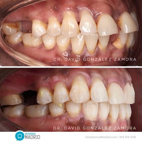 Diastema Biprotrusión Ortodoncia Madrid
