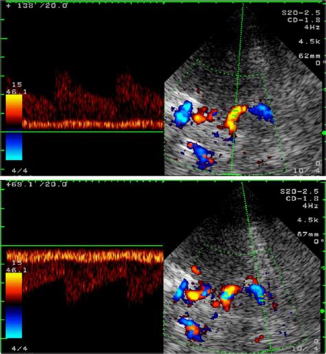 Transcranial Color Coded Duplex Sonography Of The Basal Vein Of
