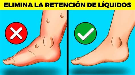 ELIMINA LA RETENCIÓN DE LÍQUIDOS EN LOS PIES Y PIERNAS Dolor de