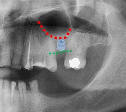 Implant Basal Techniques D Implantologie Basale La Solution Pour Vous