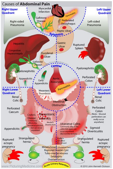Abdominal Pain Symptoms Causes