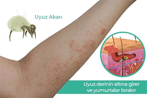 Son Günlerde Çevremizde Çokça Duymaya Başladığımız Uyuz Hastalığı 6