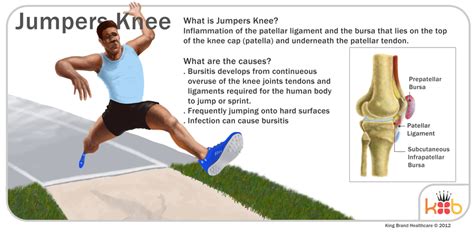 Pes Anserine Bursitis Treatment