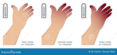 Hypothermia Of Hand Icon Vector Outline Illustration CartoonDealer
